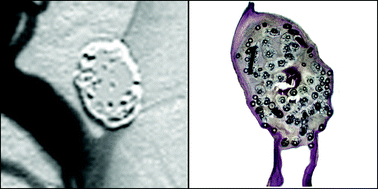 Hydrogel-coated and platinum coils for intracranial aneurysm ...