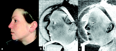 Chronic sun damage and the perception of age, health and attractiveness ...