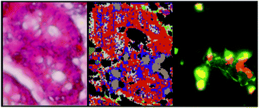 Spectral histopathology of colon cancer tissue sections by Raman ...