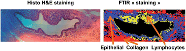 Infrared imaging in breast cancer: automated tissue component ...