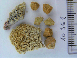Uric Acid Kidney Stone