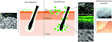 Development of a topical adapalene-solid lipid nanoparticle loaded gel ...