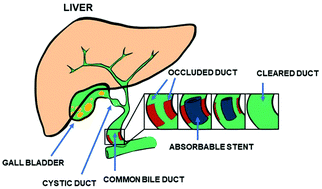 Emerging trends in biliary stents: a materials and manufacturing ...