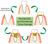 Polymeric biomaterials for periodontal tissue engineering and ...
