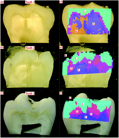 Chemical imaging of human teeth by a time-resolved Raman spectrometer ...