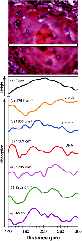 Insight into metastatic oral cancer tissue from novel analyses using ...