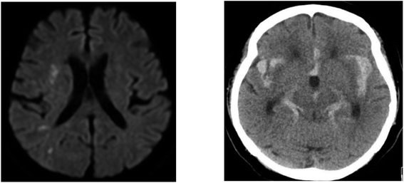 Isotope-dilution LC-MS/MS analysis of the elastin crosslinkers ...