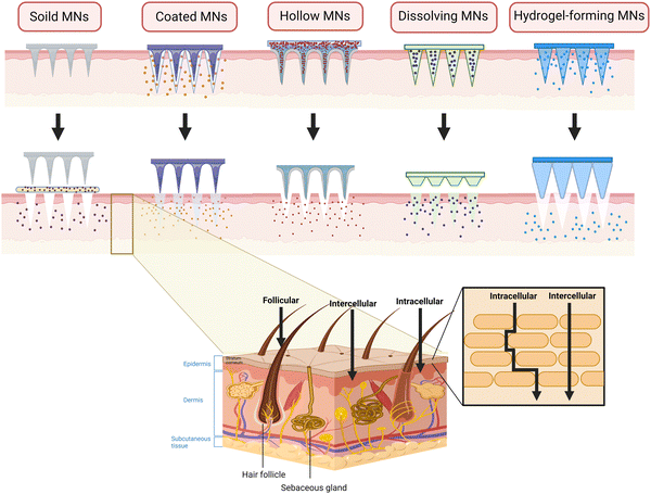 Transdermal drug delivery via microneedles for musculoskeletal systems ...